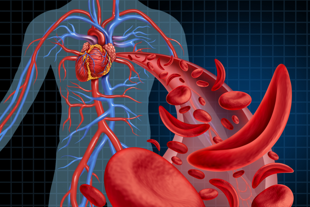 Declaración del CIRM sobre la aprobación de la FDA de terapias genéticas para la anemia de ...